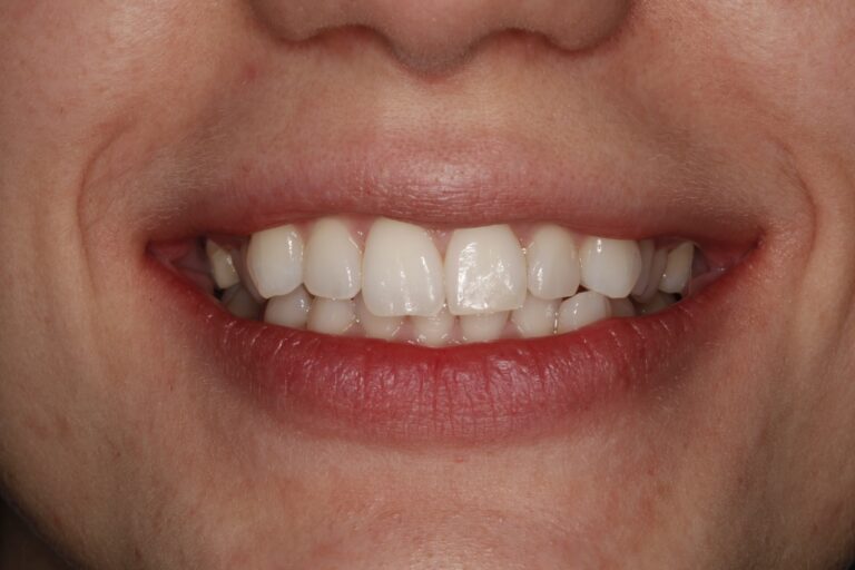 Ortodontia Tallinnas – Kaped ja Ortodontilised Lahendused | PP Ortodontia