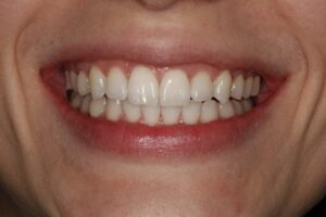 Ortodontia Tallinnas – Kaped ja Ortodontilised Lahendused | PP Ortodontia