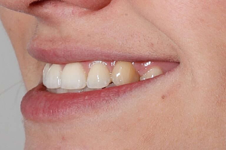 Ortodontia Tallinnas – Kaped ja Ortodontilised Lahendused | PP Ortodontia