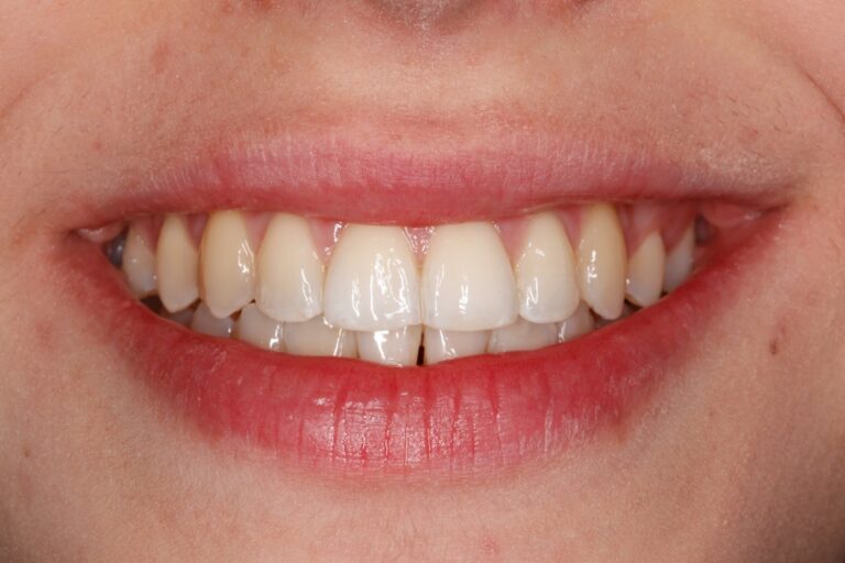 Ortodontia Tallinnas – Kaped ja Ortodontilised Lahendused | PP Ortodontia